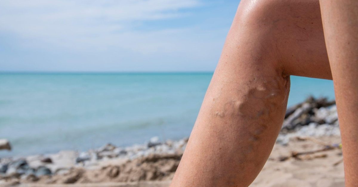 spider-vein-treatment-near-national-harbor | National Vascular Physicians