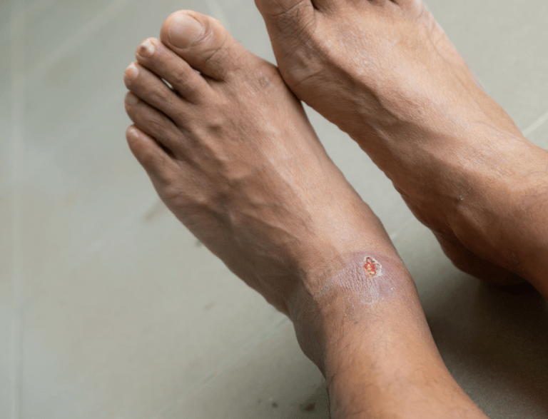 Leg Ulcers | National Vascular Physicians